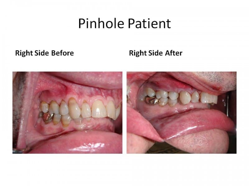 Pinhole Surgery Technique - Gum Recession & PST | Geneva IL Dentist