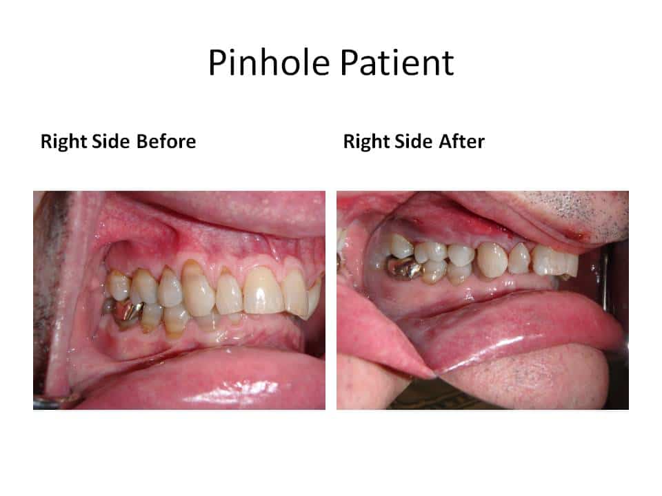Pinhole Surgery Technique - Gum Recession & PST | Geneva IL Dentist
